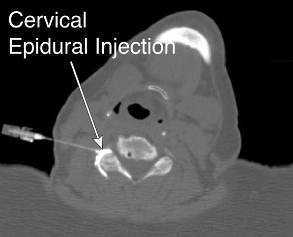 Epidural Steroid Injection | Larkin Health